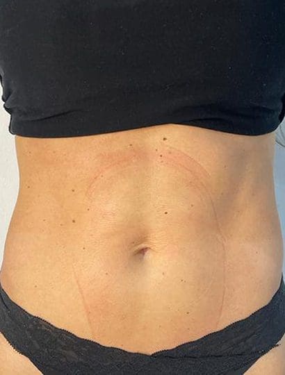 Ultra Tesla | HI-EMT Machine | Sculpt Pro Aesthetics